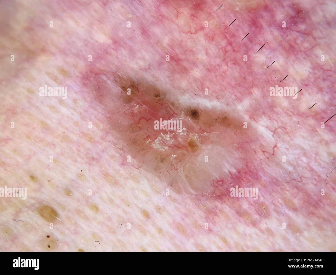 Basal cell carcinoma, dermoscopy Stock Photo - Alamy
