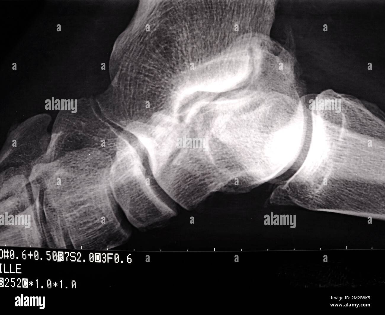 Médical | Médical radiographie du pied cheville 26/11/2017 Stock Photo ...