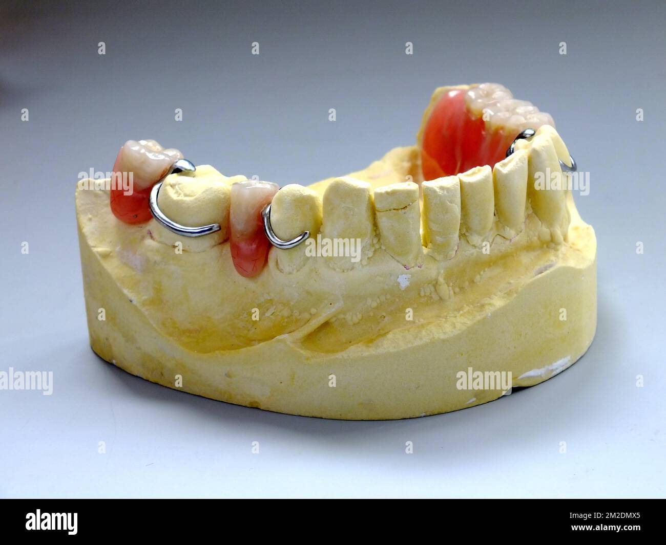 Dental prosthesis | Prothèse dentaire emprinte en platre et prothèse 13 ...