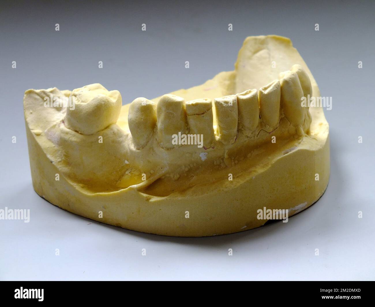 Dental prosthesis | Prothèse dentaire emprinte en platre pour ...