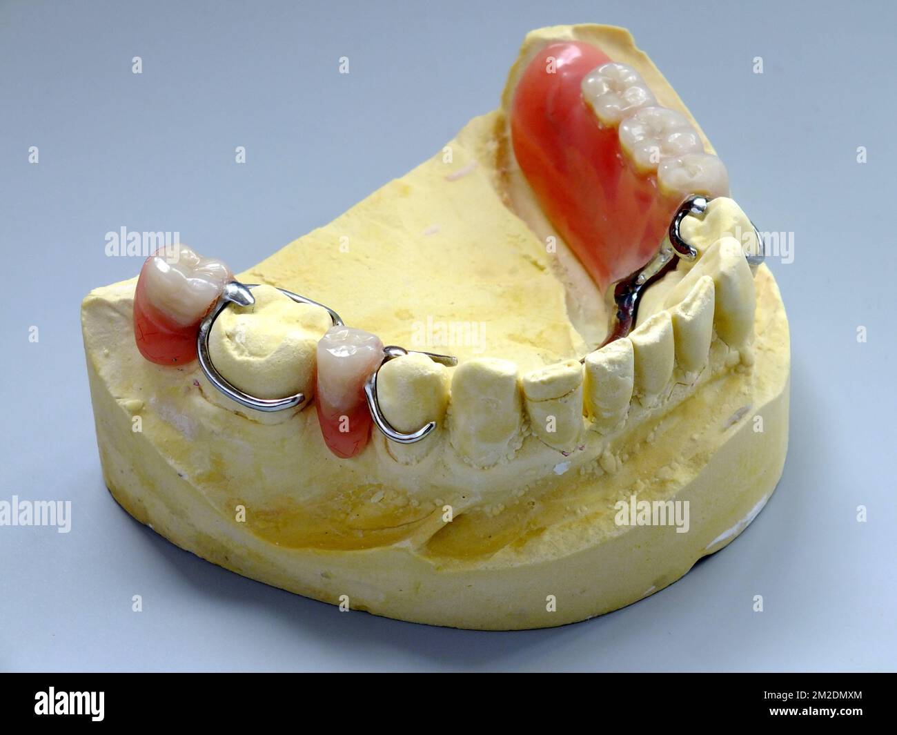 Dental prosthesis | Prothèse dentaire emprinte en platre et prothèse 13 ...
