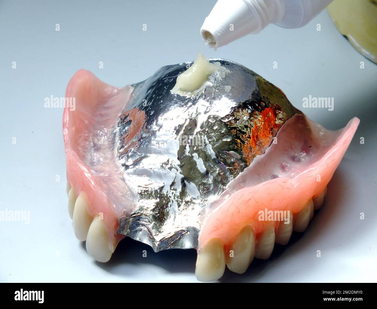 Dental prosthesis | Prothèse dentaire fixation 13/03/2018 Stock Photo ...