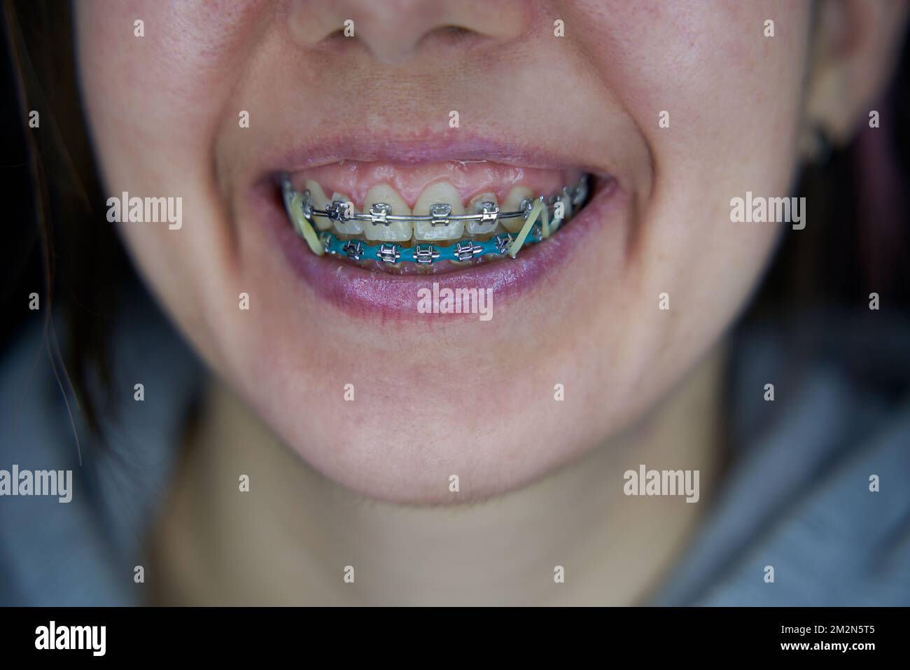 Metal Bracket Braces