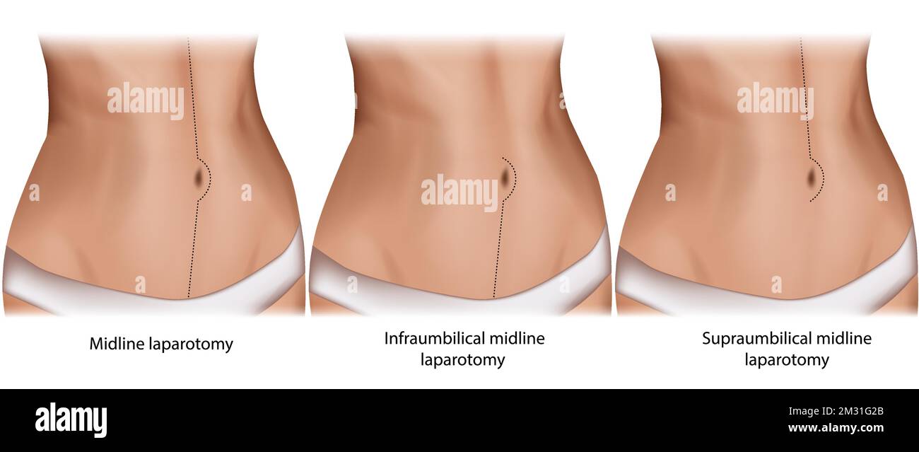 Infraumbilical Stock Vector Images Alamy Infraumbilical Stock Vector Images Alamy