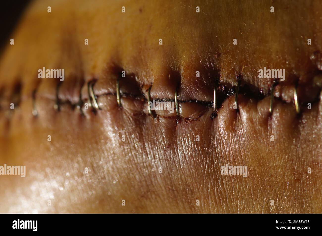 Surgical suture on the knee. Surgical wound sutured with special metal ...
