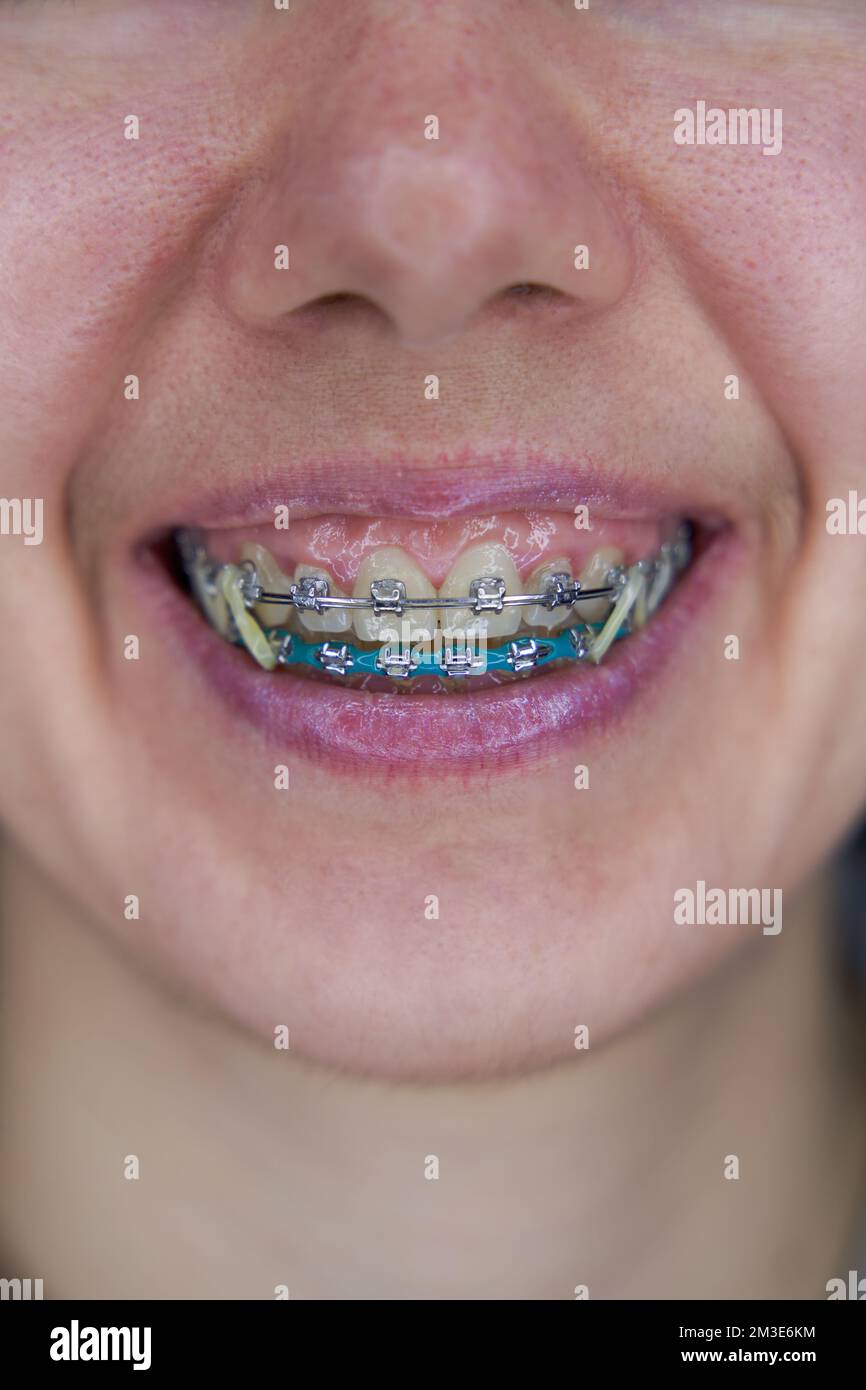 Closeup metal brackets on teeth. Smile with braces. Concept of dental ...