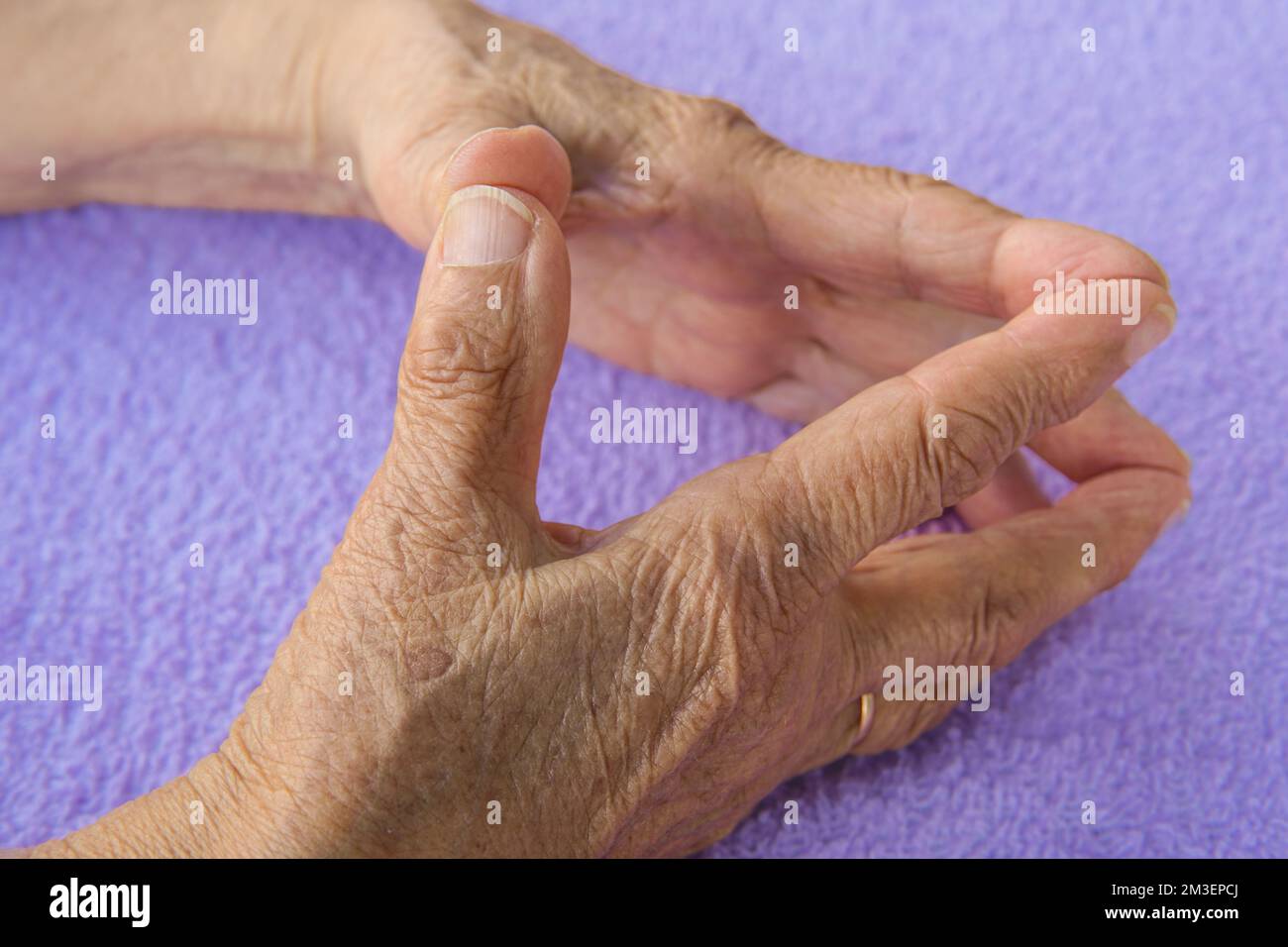 hands of old woman with bone pain and wrinkles. arthritis disease ...