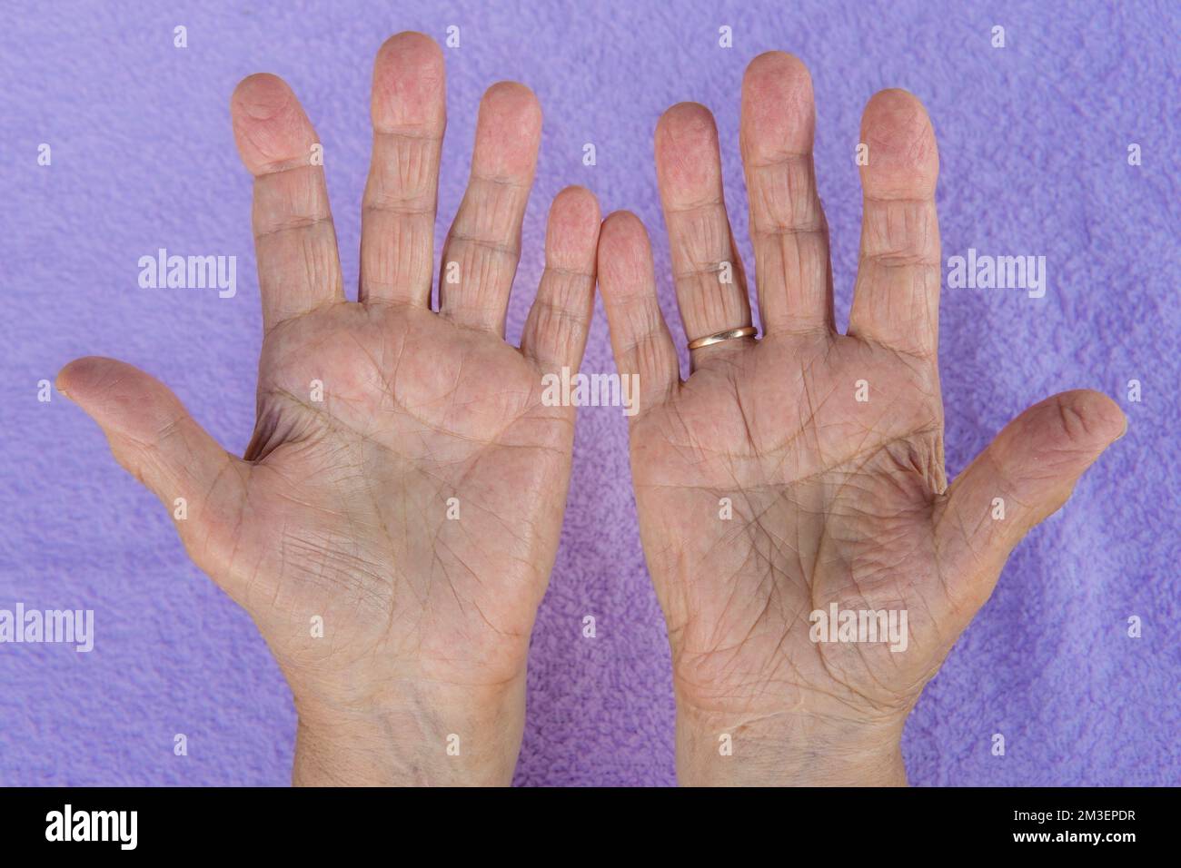Lady palm hands with arthritis on purple background Stock Photo - Alamy