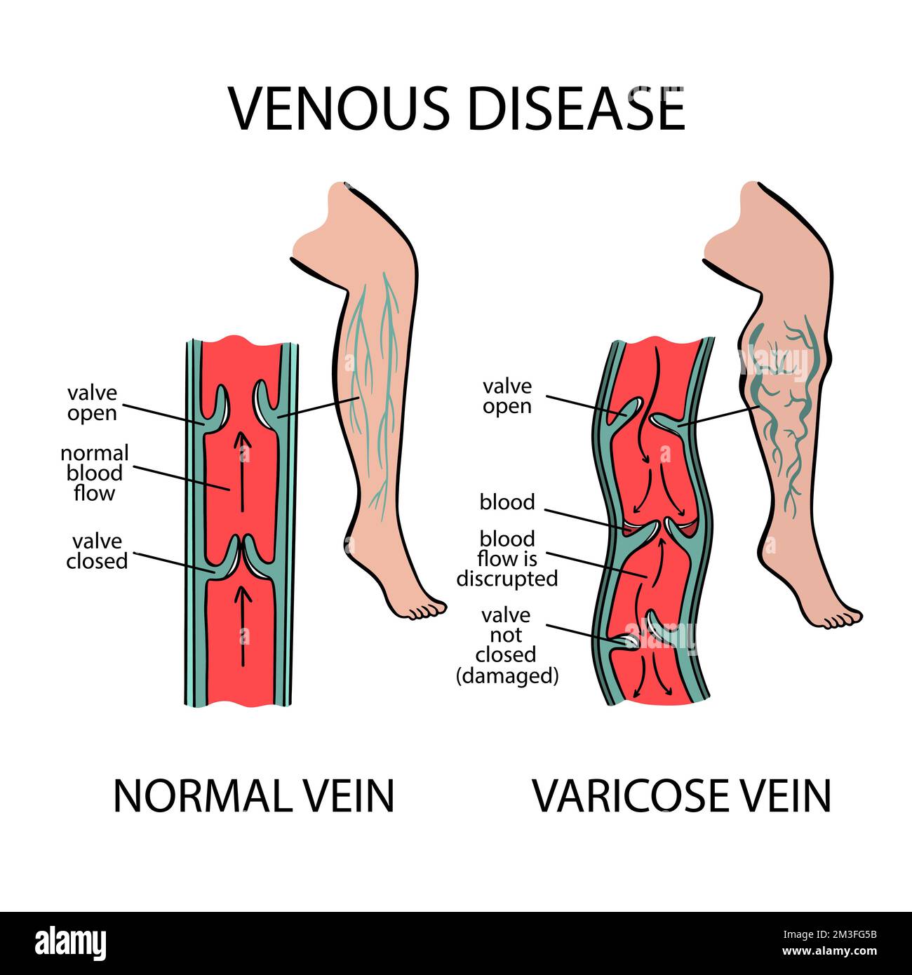 Varicose veins in legs hi-res stock photography and images - Alamy