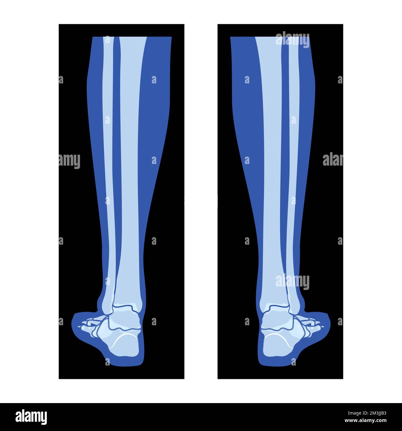 X Ray Foot Legs Skeleton Fibula Tibia Phalanges Human Body Bones Adult People Roentgen Back