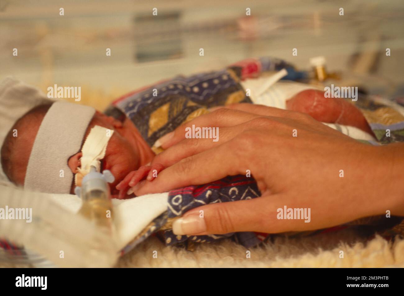 Premature newborn baby with eyes covered and feeding tube taped to its ...