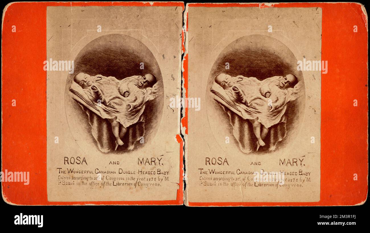 Rosa and Mary. The wonderful Canadian double-headed baby , Human ...