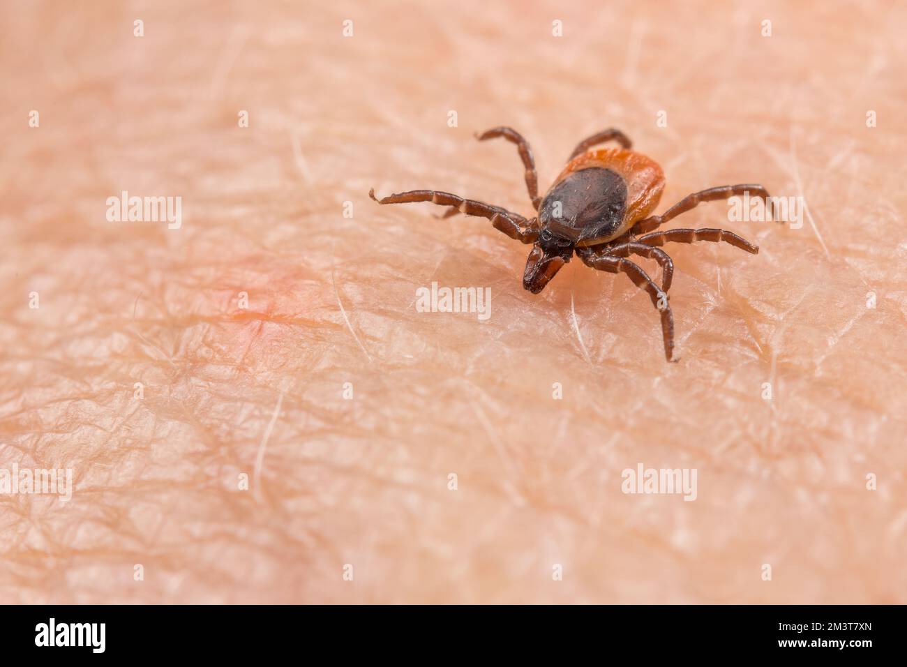 Parasitic castor bean tick at biting to a human skin. Ixodes ricinus ...