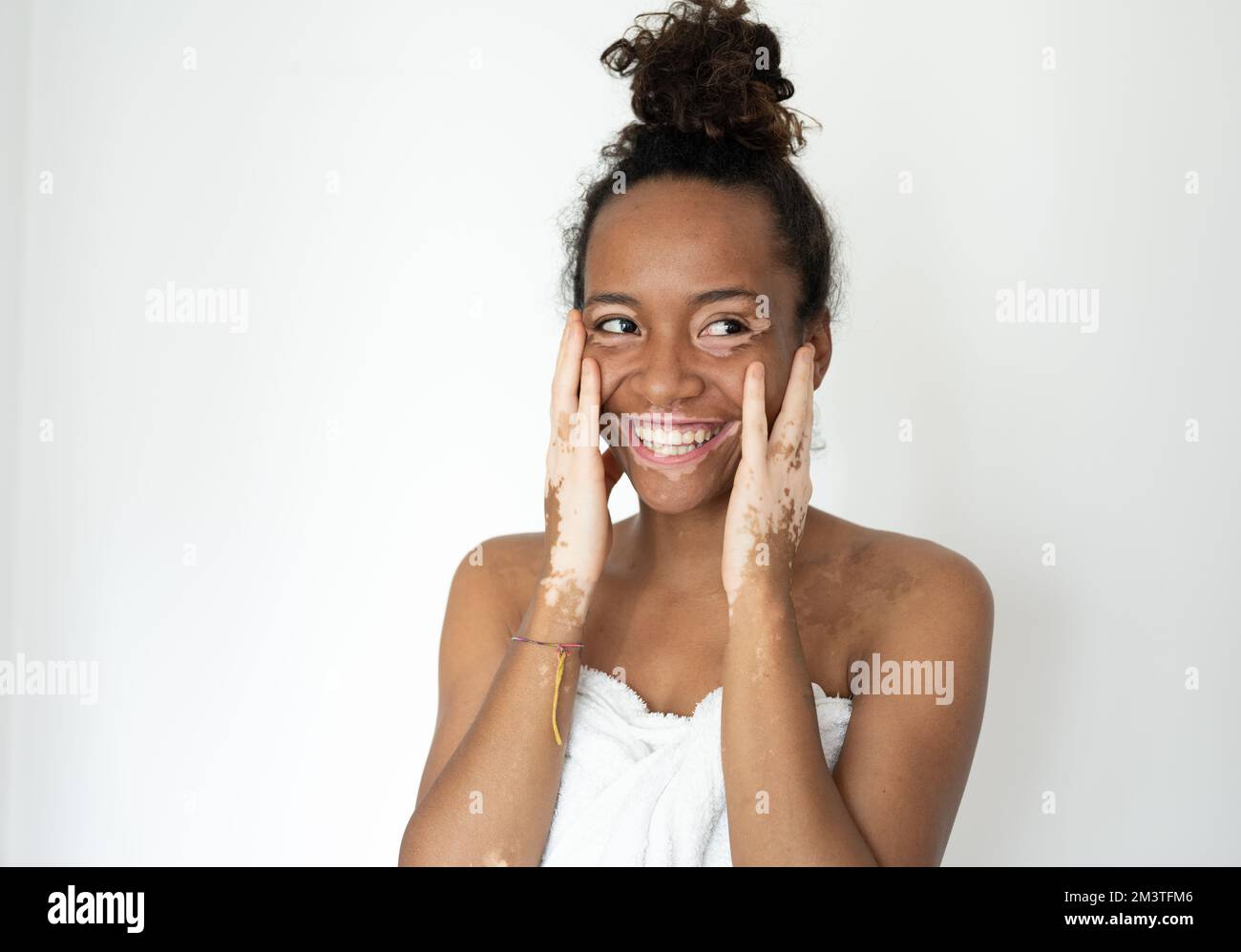 Beautiful young brazilian woman with vitiligo posing with towel, skin ...