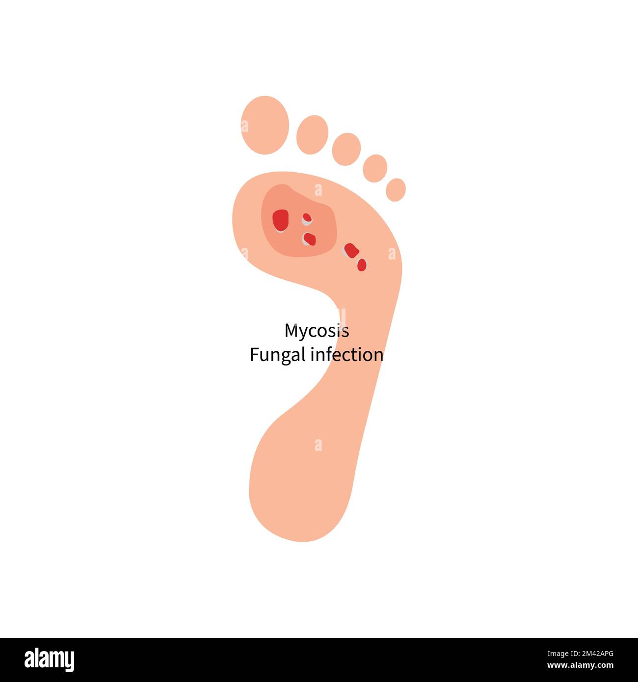 Foot with fungal skin disease Stock Vector Image & Art - Alamy