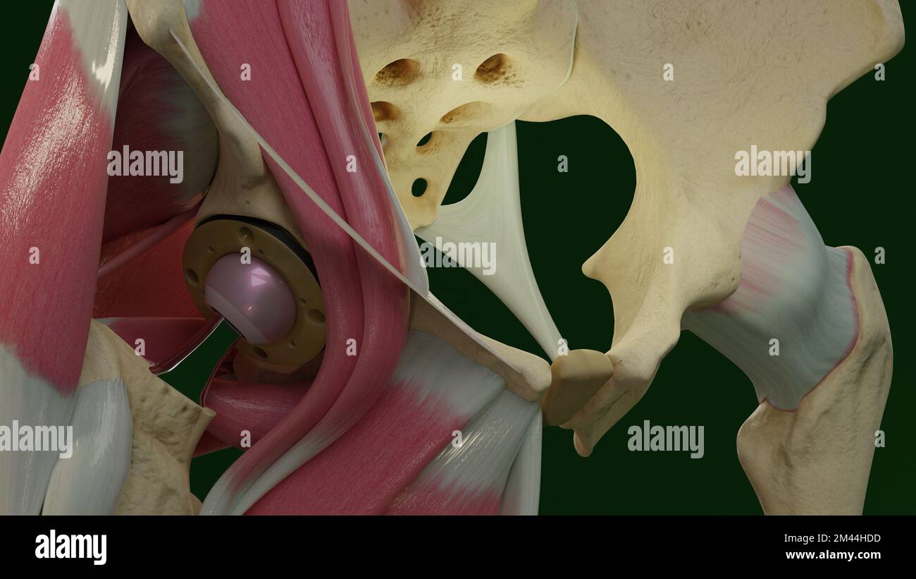Hip replacement, prosthetic hip joint, exposed muscles Stock Photo - Alamy