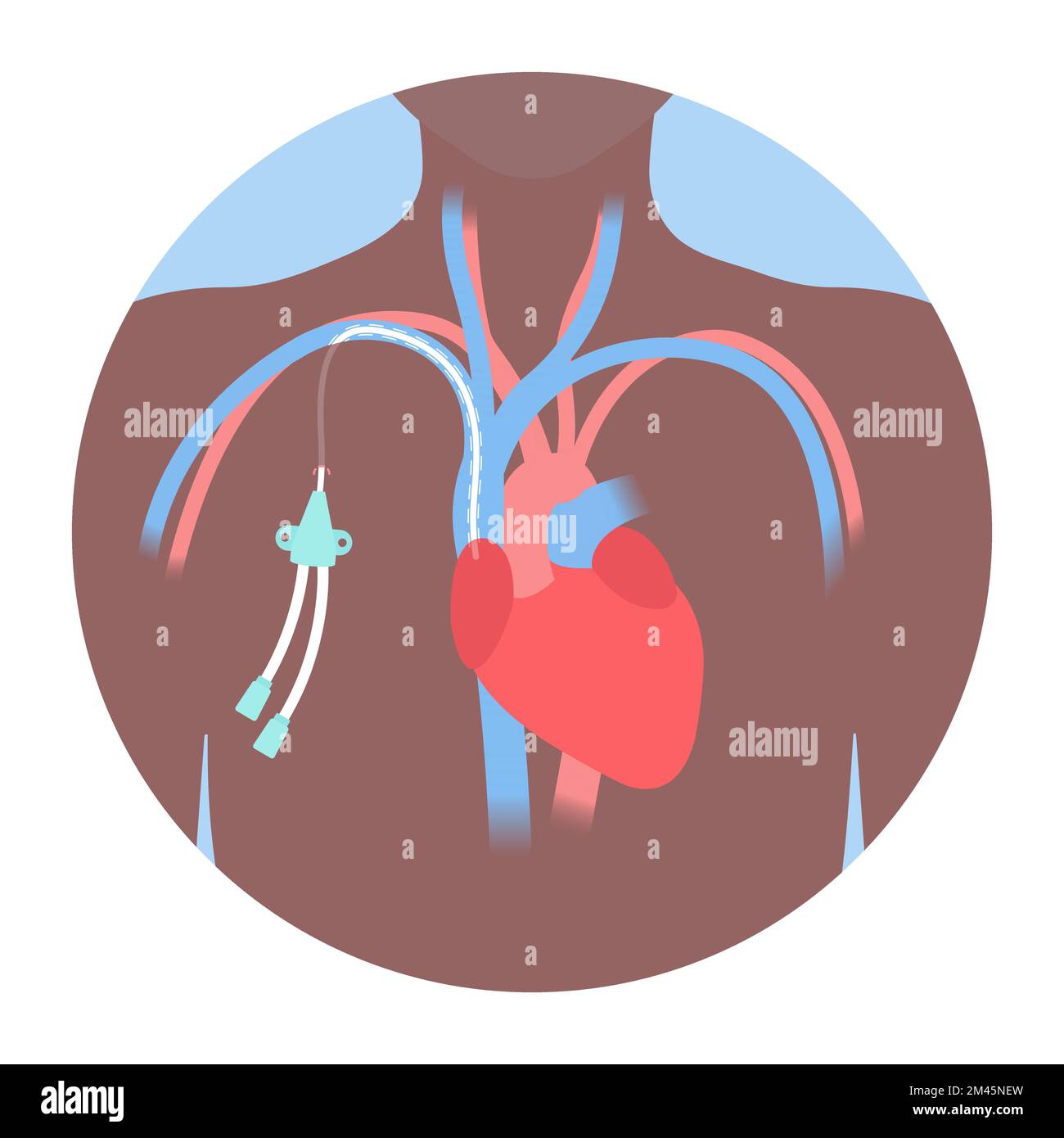 Tunneled central line venous catheter medical diagram Stock Vector ...