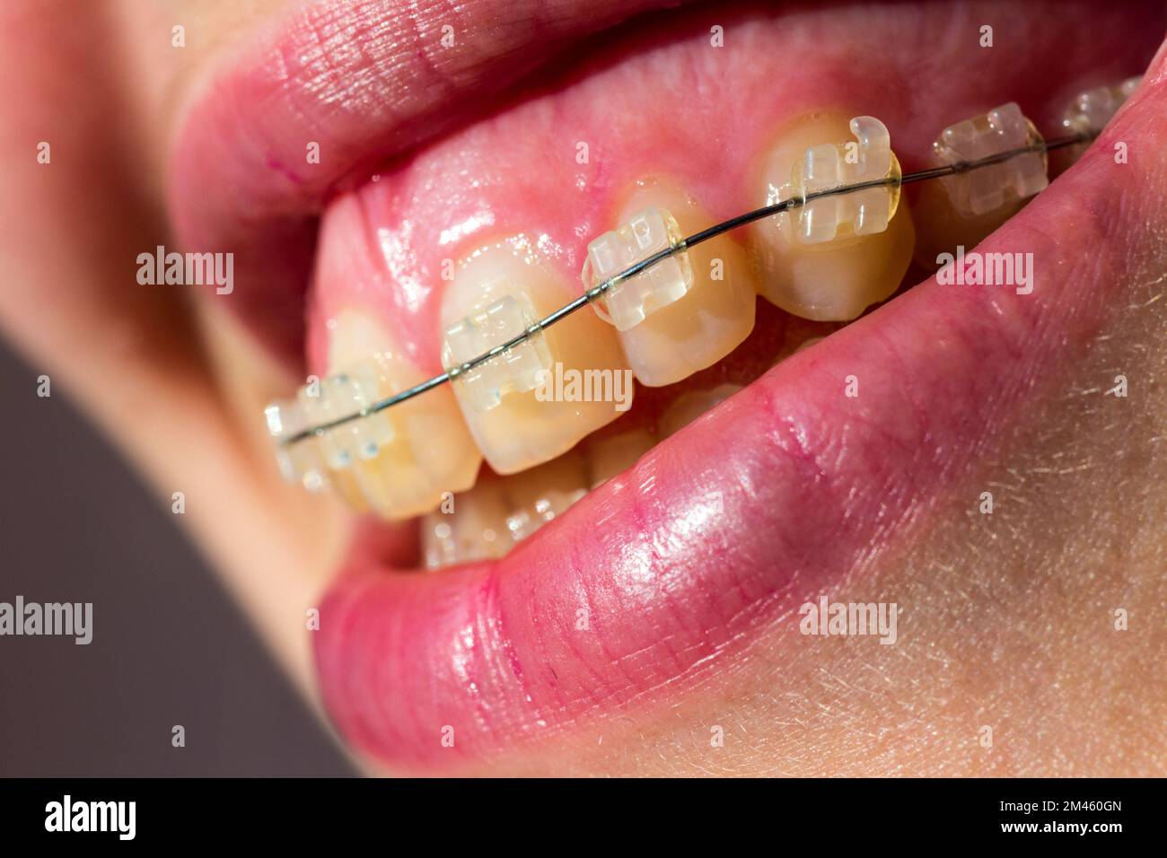 Close-up of young woman mouth, fixed braces with ceramic brackets Stock ...