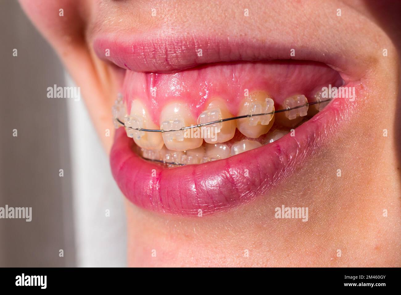 Fixed braces with ceramic brackets hi-res stock photography and images ...