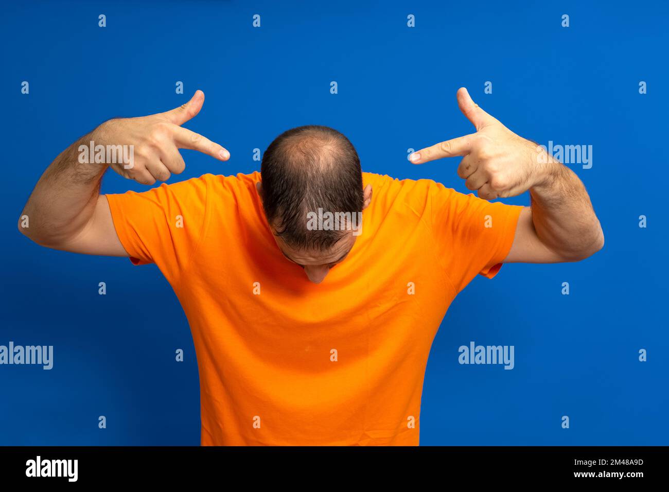 Human alopecia or hair loss. Middle-aged Latino man pointing to his ...