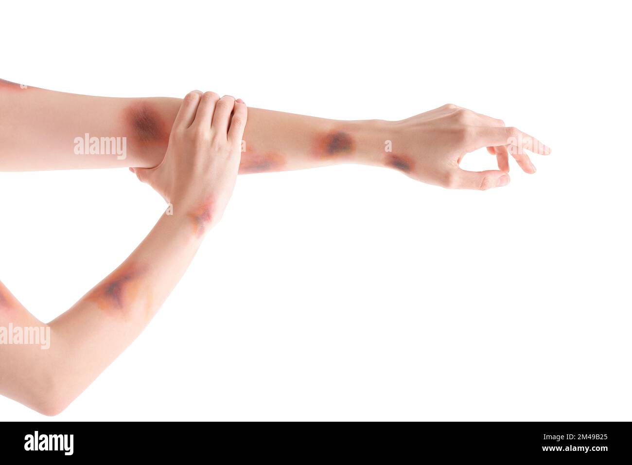 Bruised female hands on white background Stock Photo - Alamy