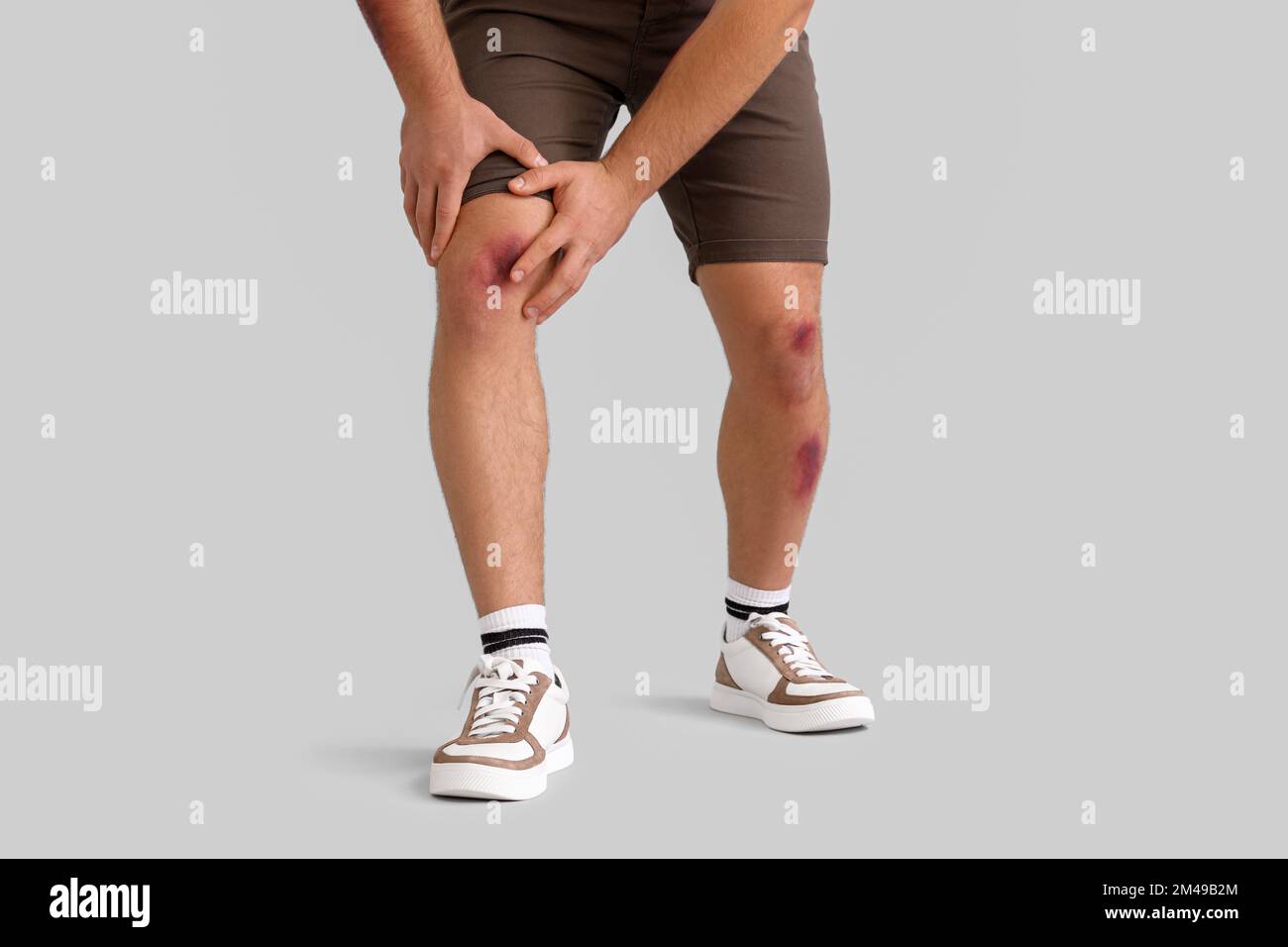 Man with bruises on legs against light background Stock Photo - Alamy