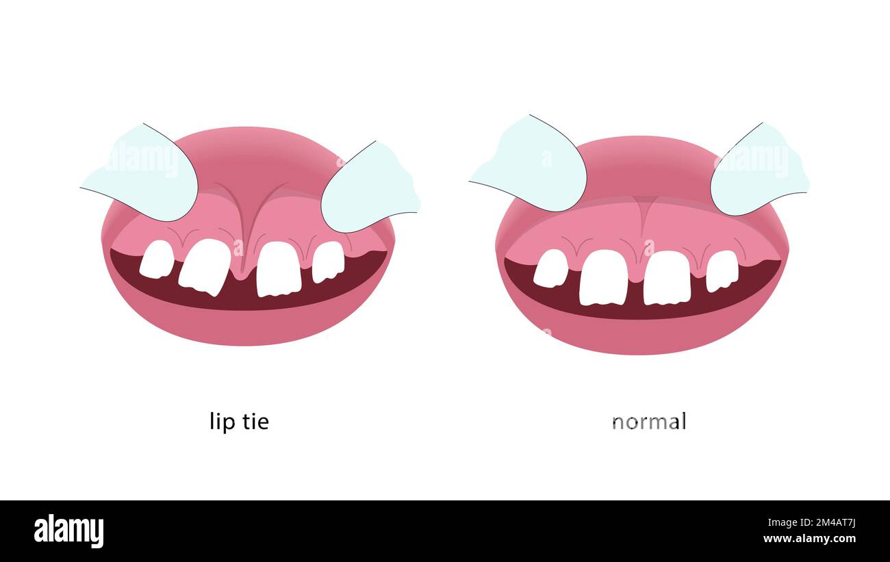 Labial Frenulum Normal
