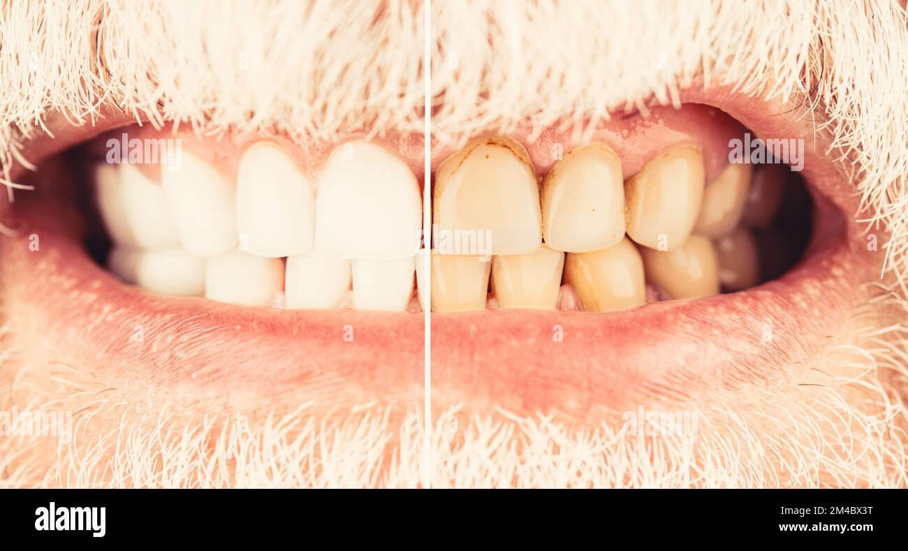 Smiling man Teeth Before And After Whitening. Male teeth before and ...