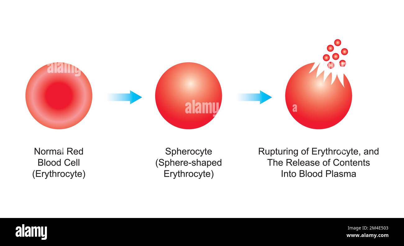 Scientific Designing of Hemolysis. The Destruction of Red Blood Cells ...