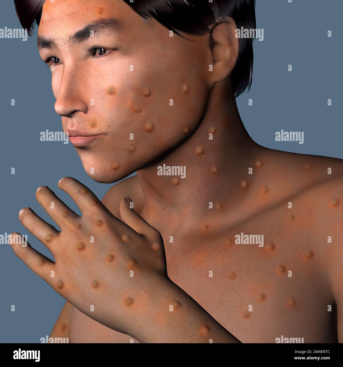 Monkeypox infection, illustration Stock Photo - Alamy