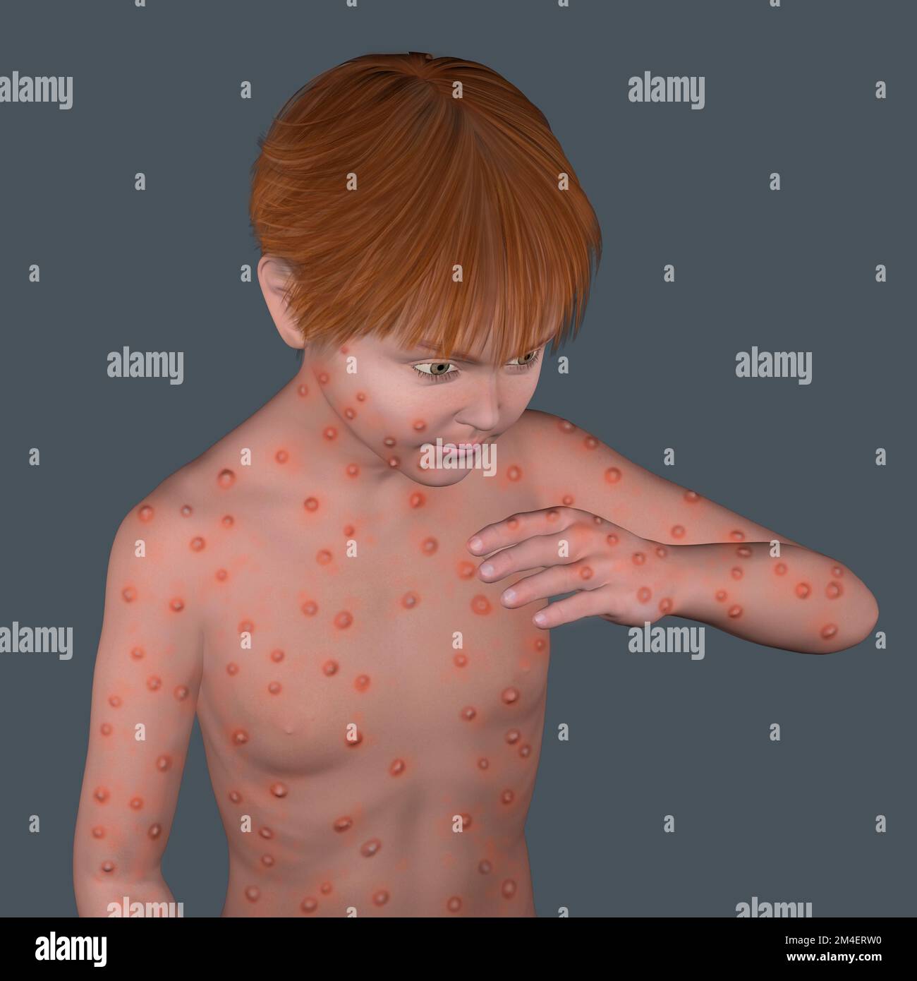 Monkeypox infection, illustration Stock Photo - Alamy