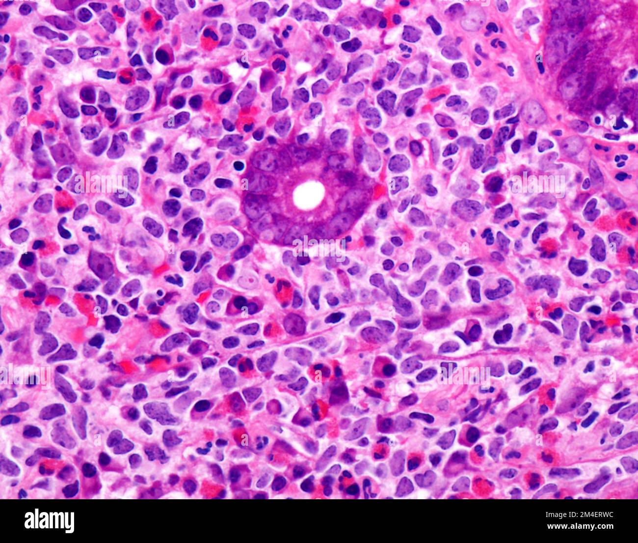 Mantle cell lymphoma, light micrograph Stock Photo - Alamy