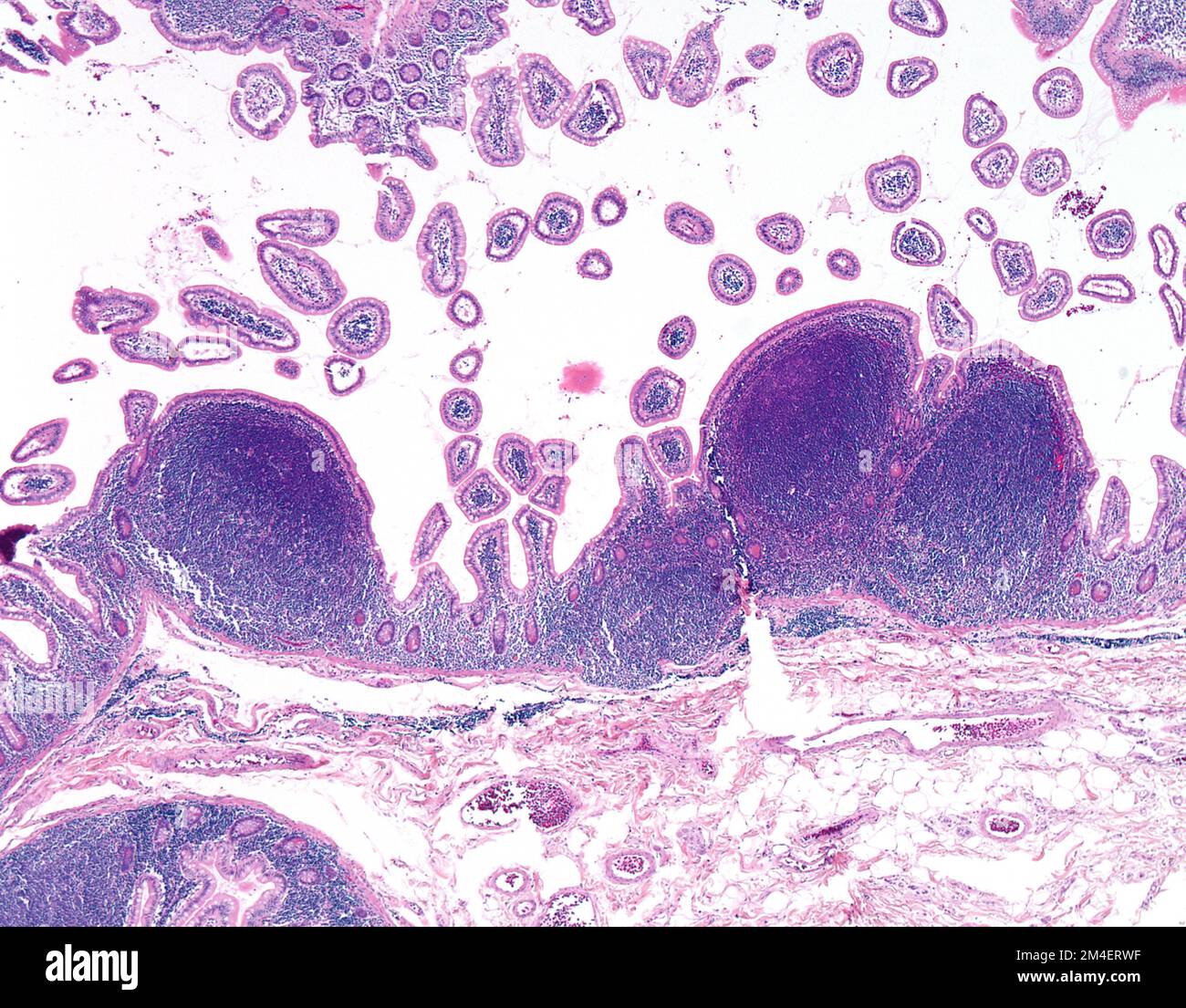 Mantle cell lymphoma, light micrograph Stock Photo - Alamy