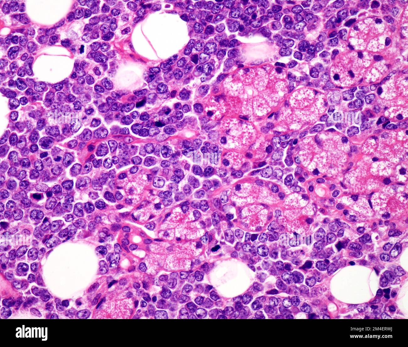 Mantle cell lymphoma, light micrograph Stock Photo - Alamy