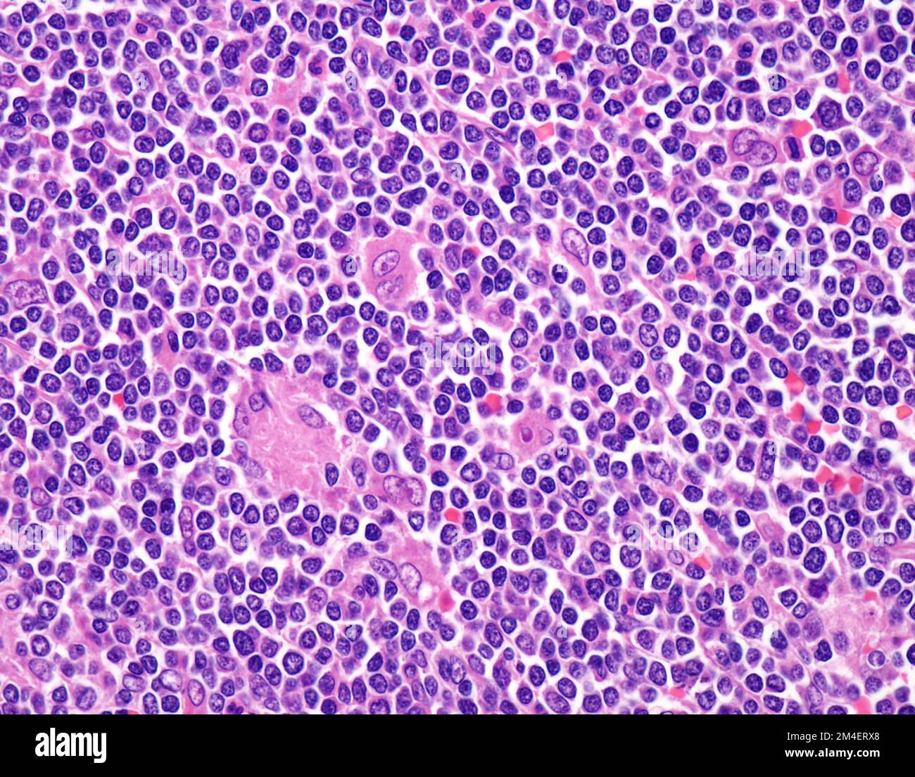 Mantle cell lymphoma, light micrograph Stock Photo - Alamy