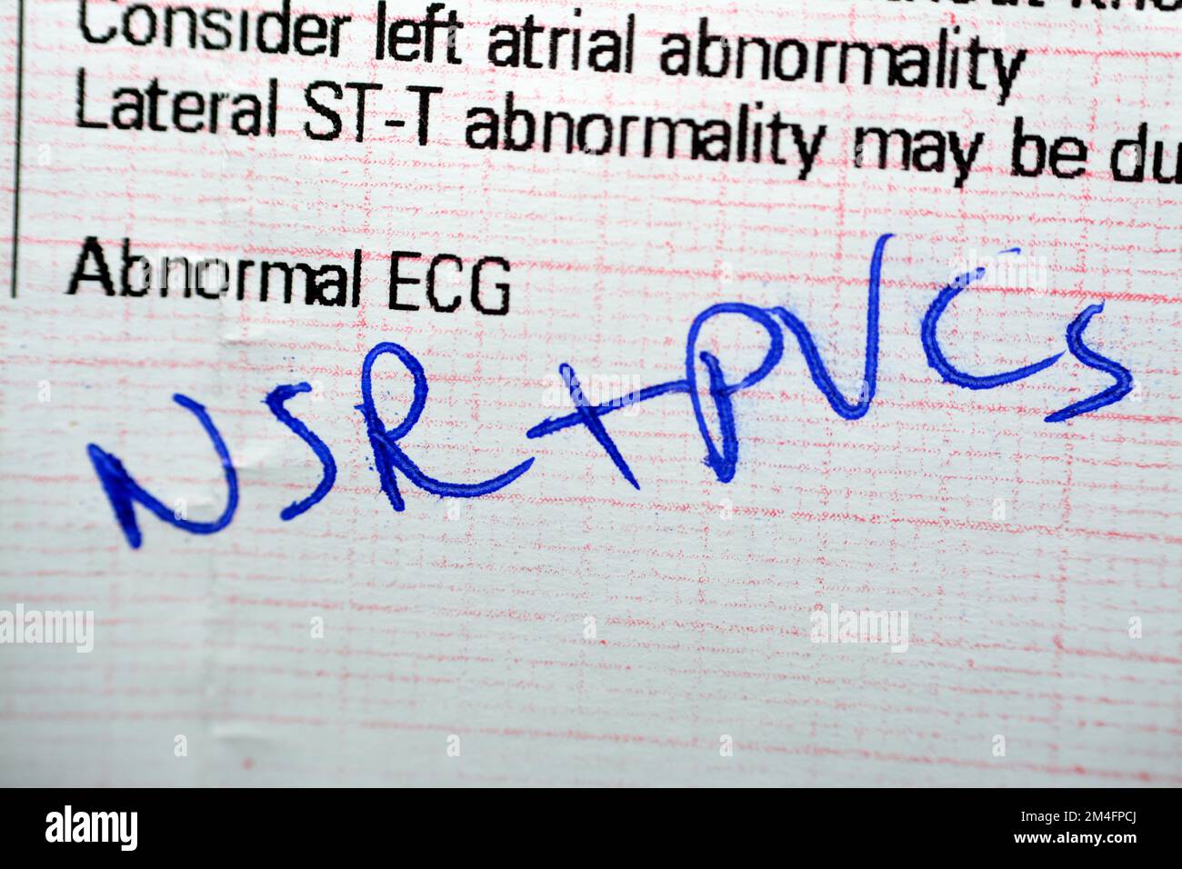 Premature Atrial Contractions Vs Premature Ventricular Contractions