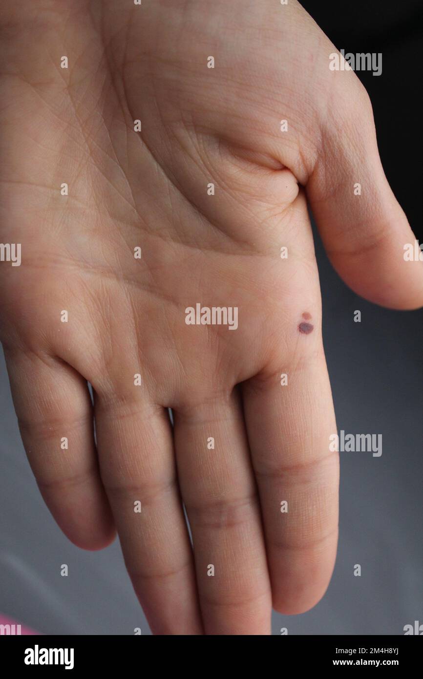 a flaw in the skin on the hand of the palm. bruising bruise mole close ...