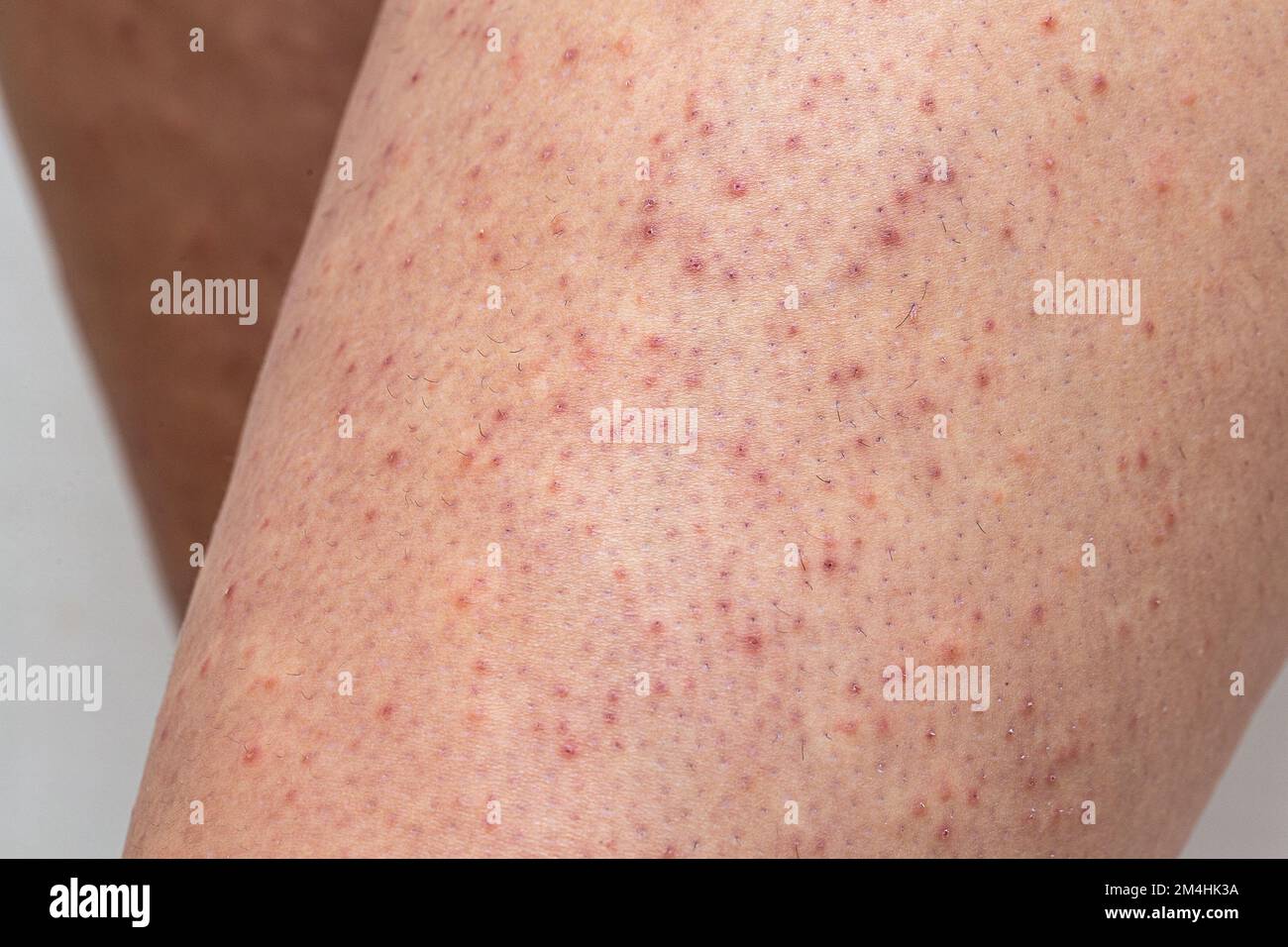 Keratosis Pilaris Chest