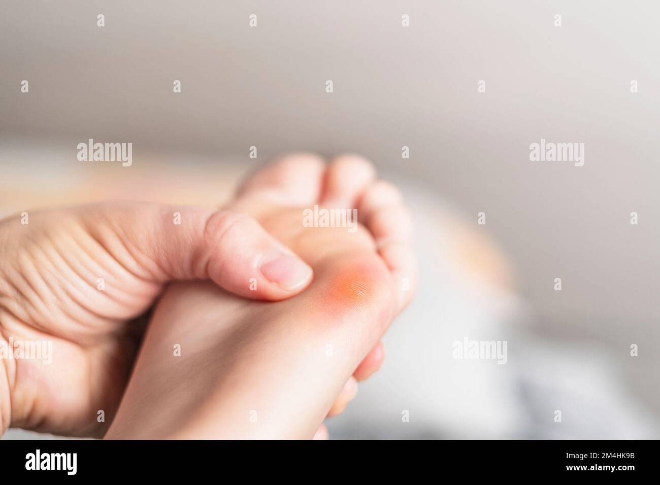 Plantar callosity hi-res stock photography and images - Alamy