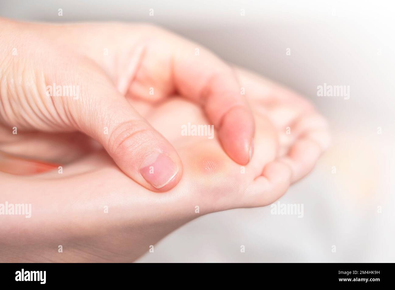 Close up of calluses. Problem skin on the steps of a teenager Stock ...