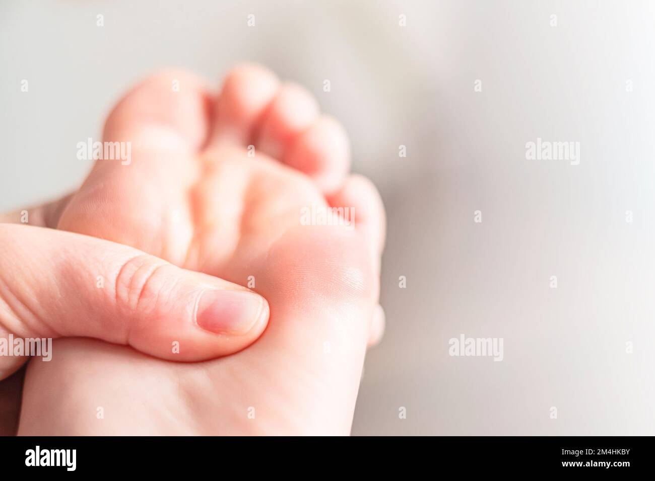 Close up of calluses. Problem skin on the steps of a teenager Stock ...
