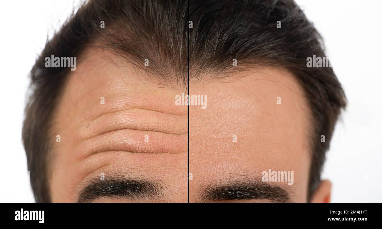 face of a man before and after a cosmetic treatment to smooth ...