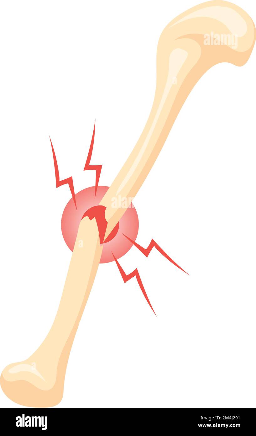 Broken bone icon. Cartoon medical fracture illustration isolated on ...