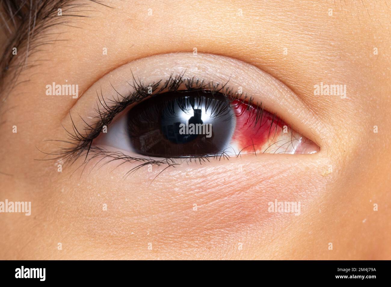 Macro of kid eye with subconjunctival hemorrhage. Blood stain in the ...