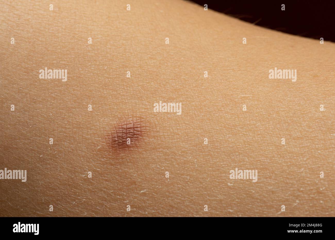 Blemish on the skin of woman's leg, prevention concept for moles and ...
