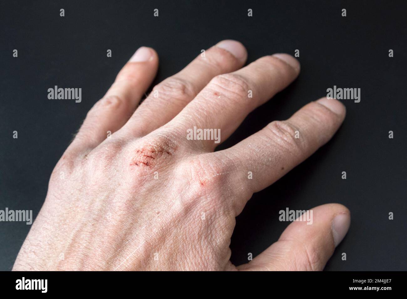 Chapped hands from cold weather, dry cracked knuckles Stock Photo - Alamy