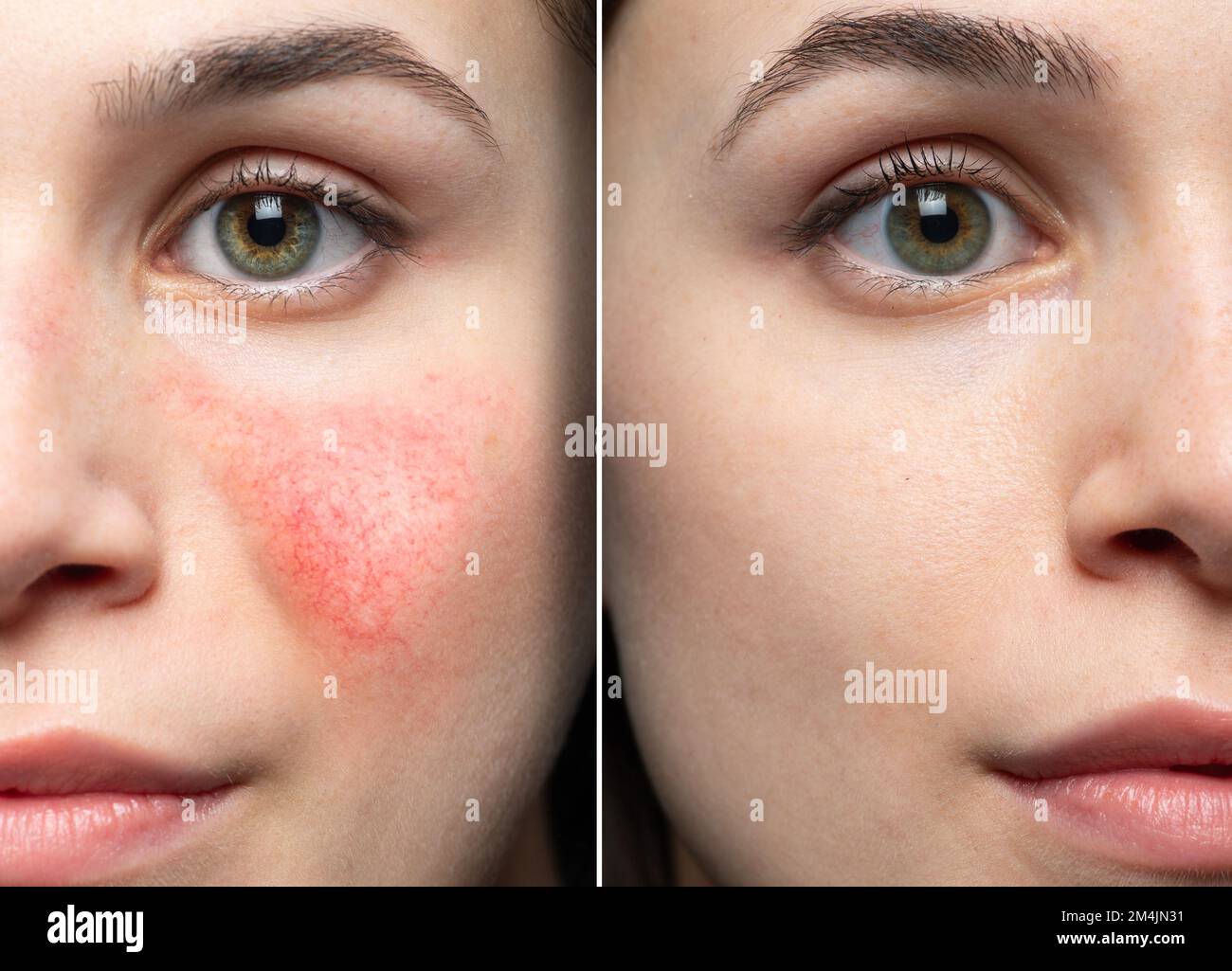 Acne Rosacea Before After