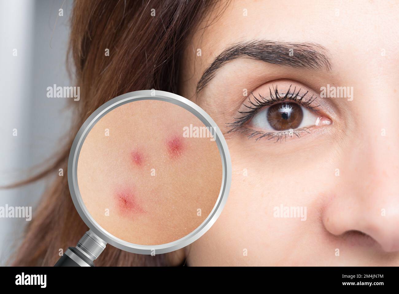 Portrait of girl with demodicosis. Magnification of a portion of skin ...