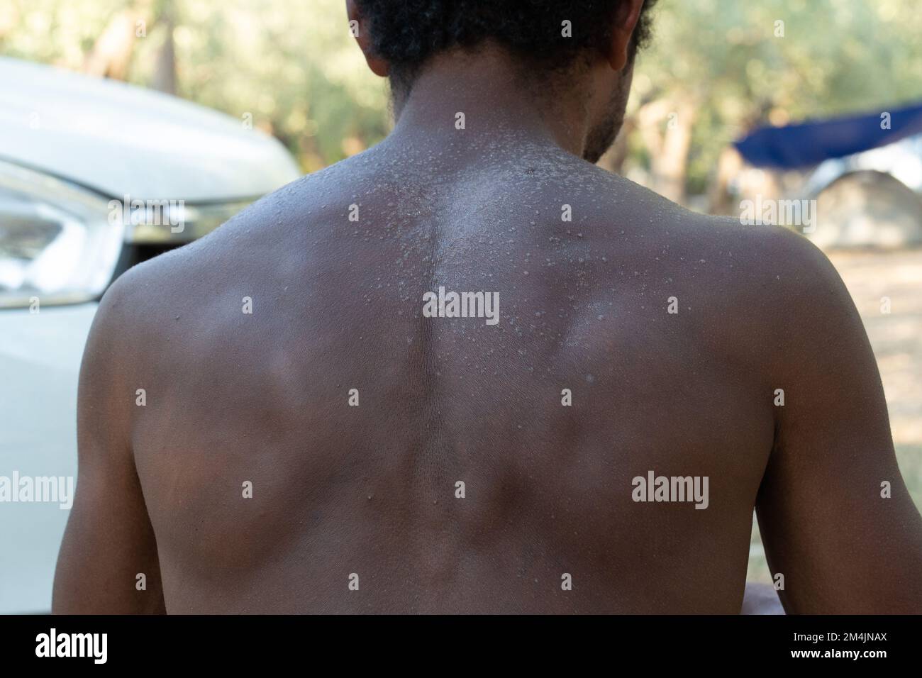 Back of a sunburned African man, full of blisters Stock Photo - Alamy