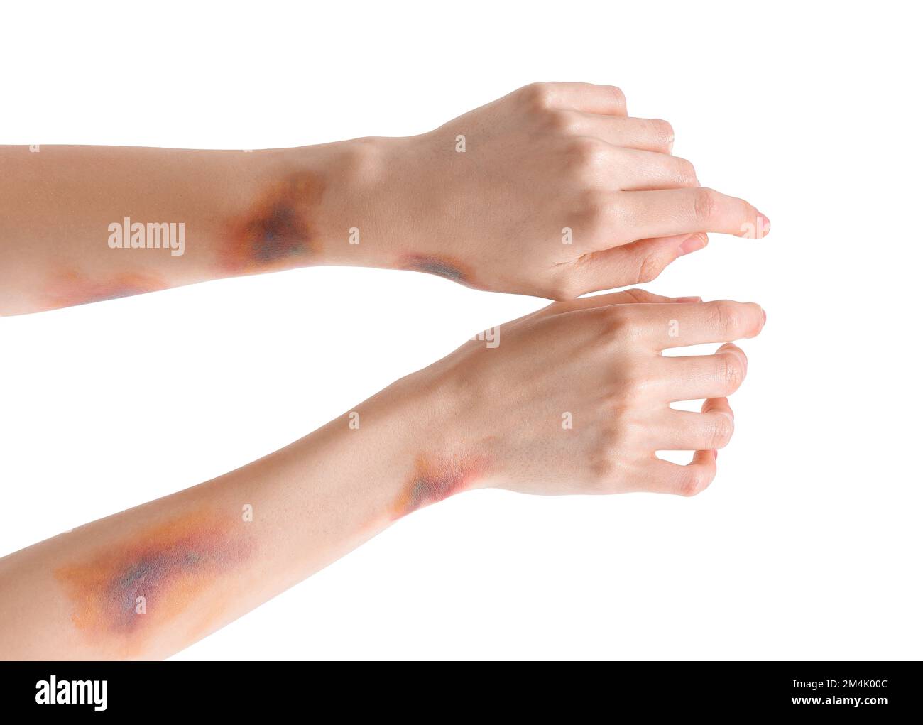 Bruised female hands on white background Stock Photo - Alamy
